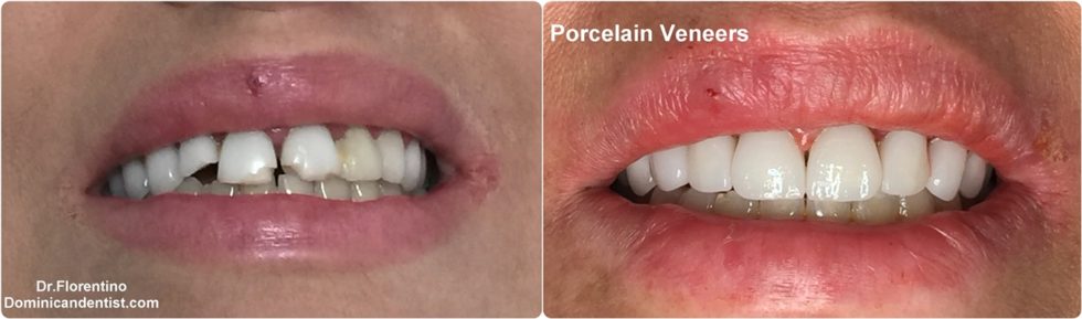 Porcelain Veneers in the Dominican Republic – Full Mouth Dental ...